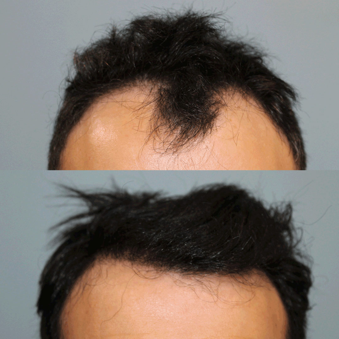 Μεταμόσχευση μαλλιών Θεσσαλονίκη | Direct Hair Clinic