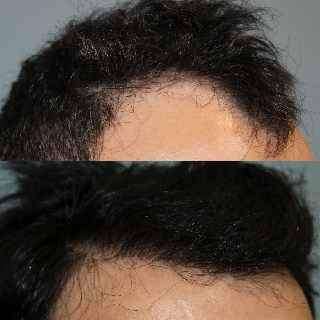 Μεταμόσχευση μαλλιών Θεσσαλονίκη | Direct Hair Clinic